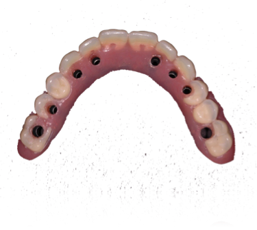 NobelGuide- CT guided dental implant placement