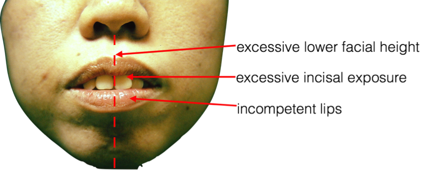 Surgical correction of bimaxillary protrusion in Singapore