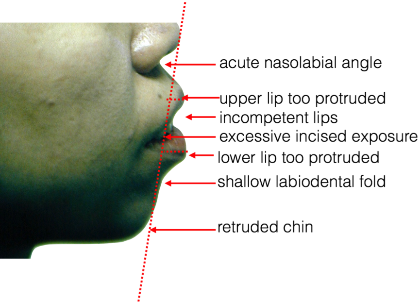 Surgical correction of bimaxillary protrusion in Singapore