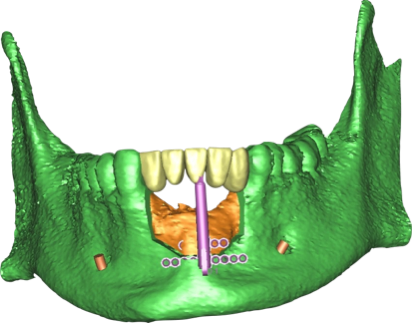 Singapore dental implant case study: distraction osteogenesis