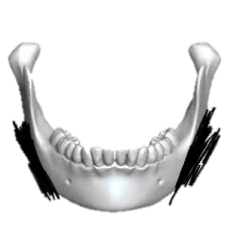 Creating the V Shape Face by jaw contouring surgery in Singapore